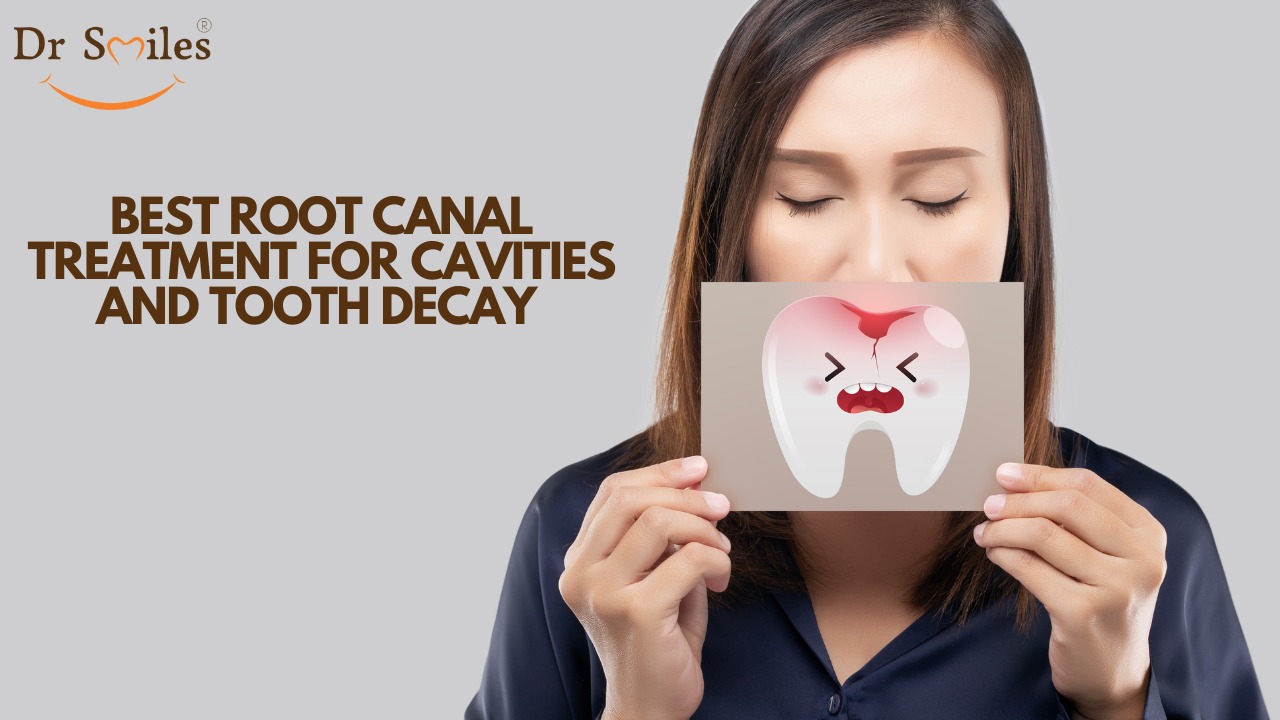 Best Root Canal Treatment for Cavities and Tooth Decay in Hyderabad