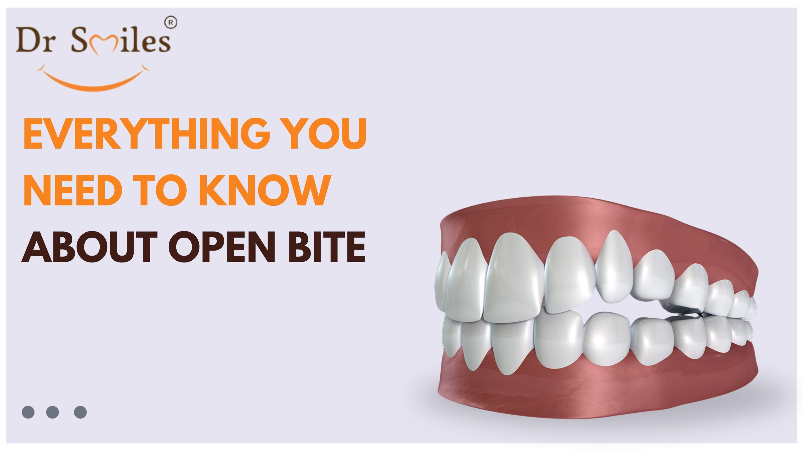 Everything You Need to Know About Open Bite: Symptoms, Causes, and ...