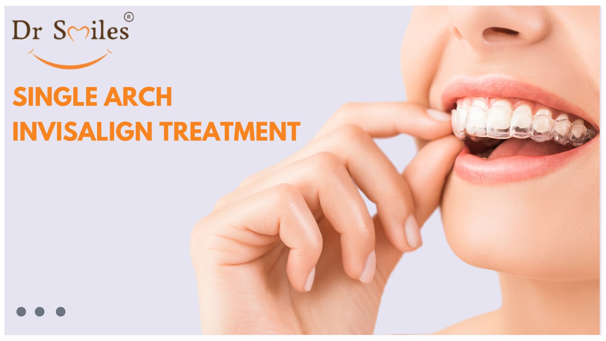 Invisalign for Just One Arch: Is It Possible and Who Needs It?